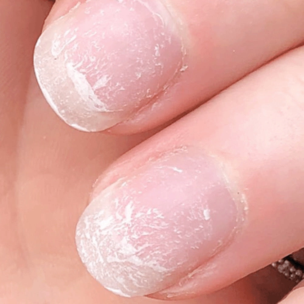 How to treat peeling nails (and stop them from coming back) – Kester ...